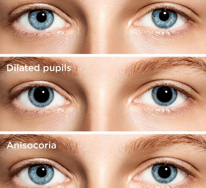 Pupil Dilation: Causes and Significance - SimplExplainer