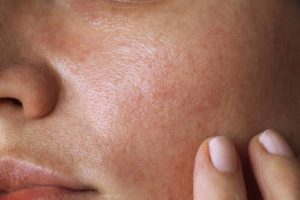 Excess Oil Production on the Skin: Causes, Effects, and Solutions ...
