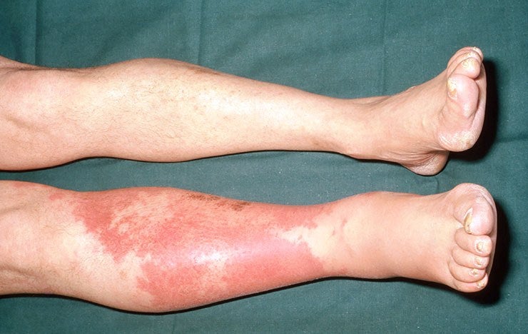 Causes of Cellulitis - SimplExplainer