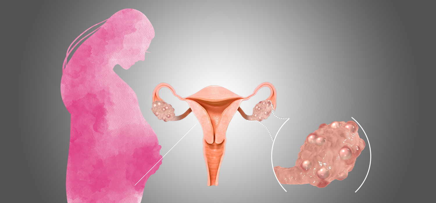 Polycystic Ovarian Syndrome - SimplExplainer