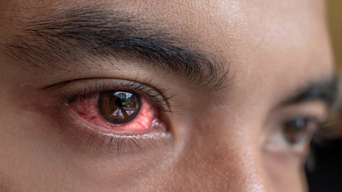 Understanding Red Eyes in Kids: Causes and Care - SimplExplainer
