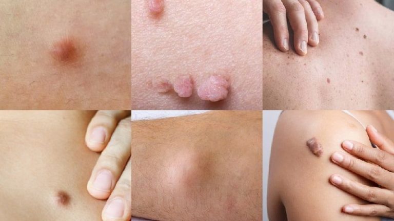 Types of Lumps - SimplExplainer